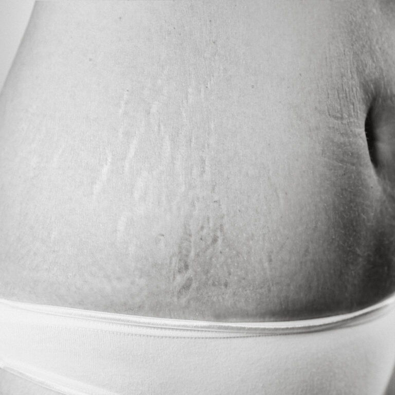 Stretch Marks - Central Wellness Medical & Aesthetic Billings MT