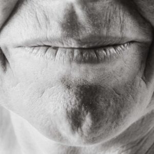 Pitted Dimpled Chin - Central Wellness Medical & Aesthetic Billings MT