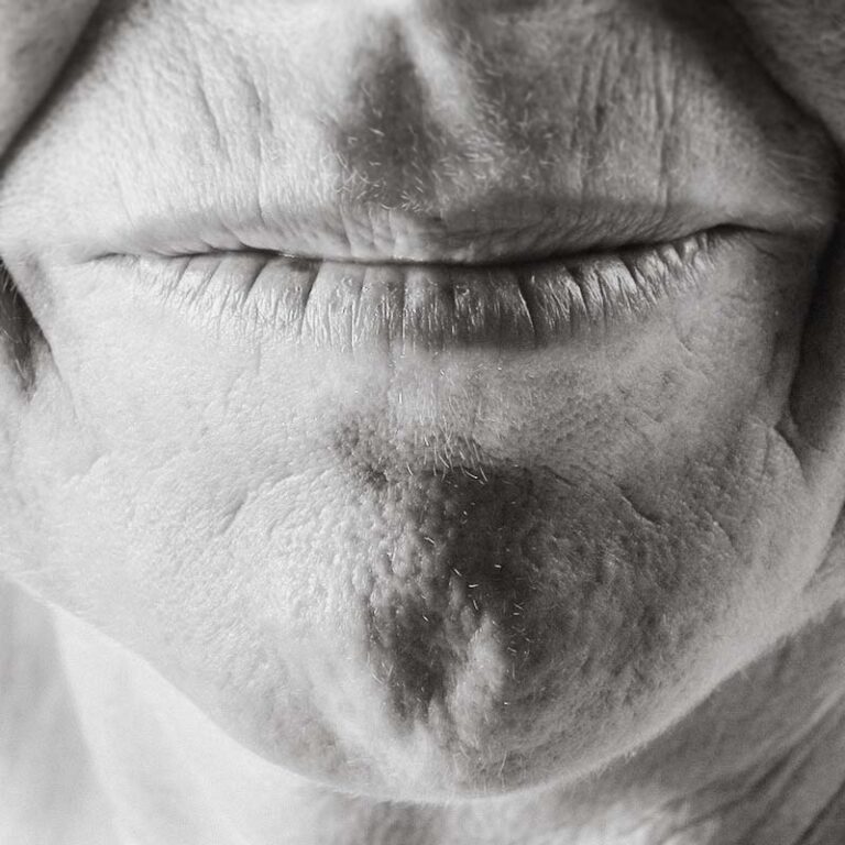 Pitted Dimpled Chin - Central Wellness Medical & Aesthetic Billings MT