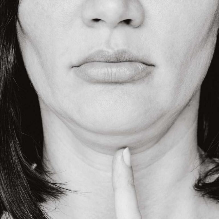 Saggy Chin - Central Wellness Medical & Aesthetic Billings MT