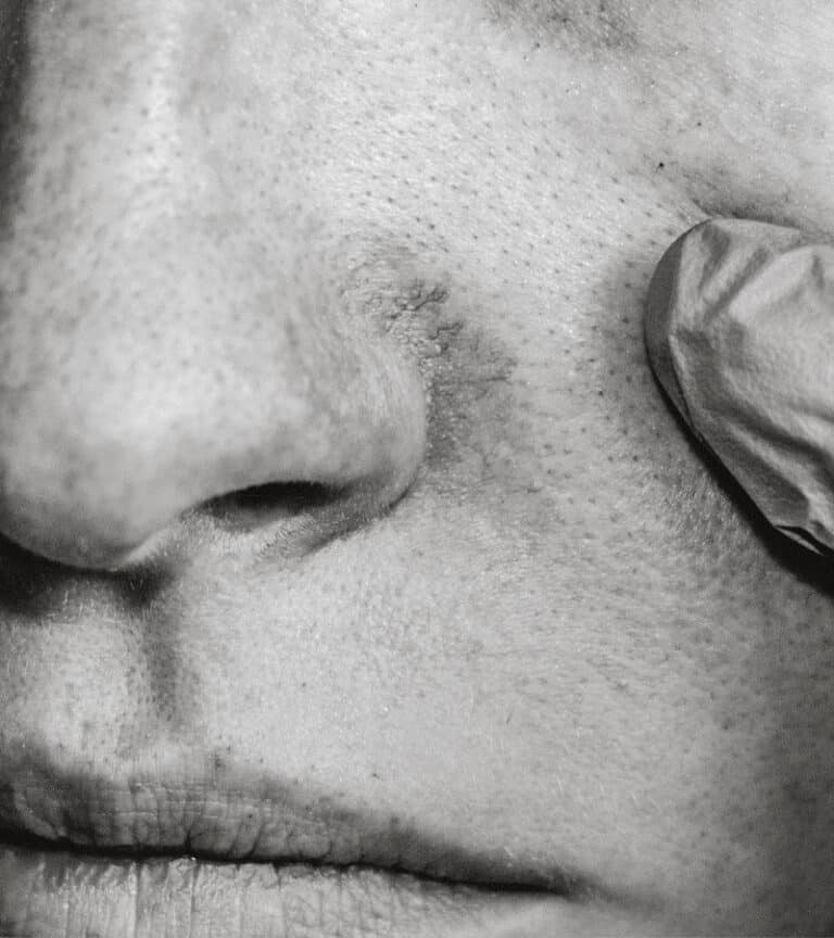 The Truth About Broken Capillaries? & 15 FAQs - Central Wellness ...