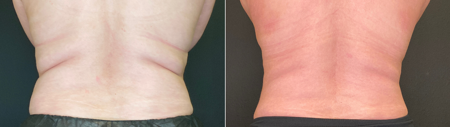 CoolSculpting® Real Client Stories - Central Wellness