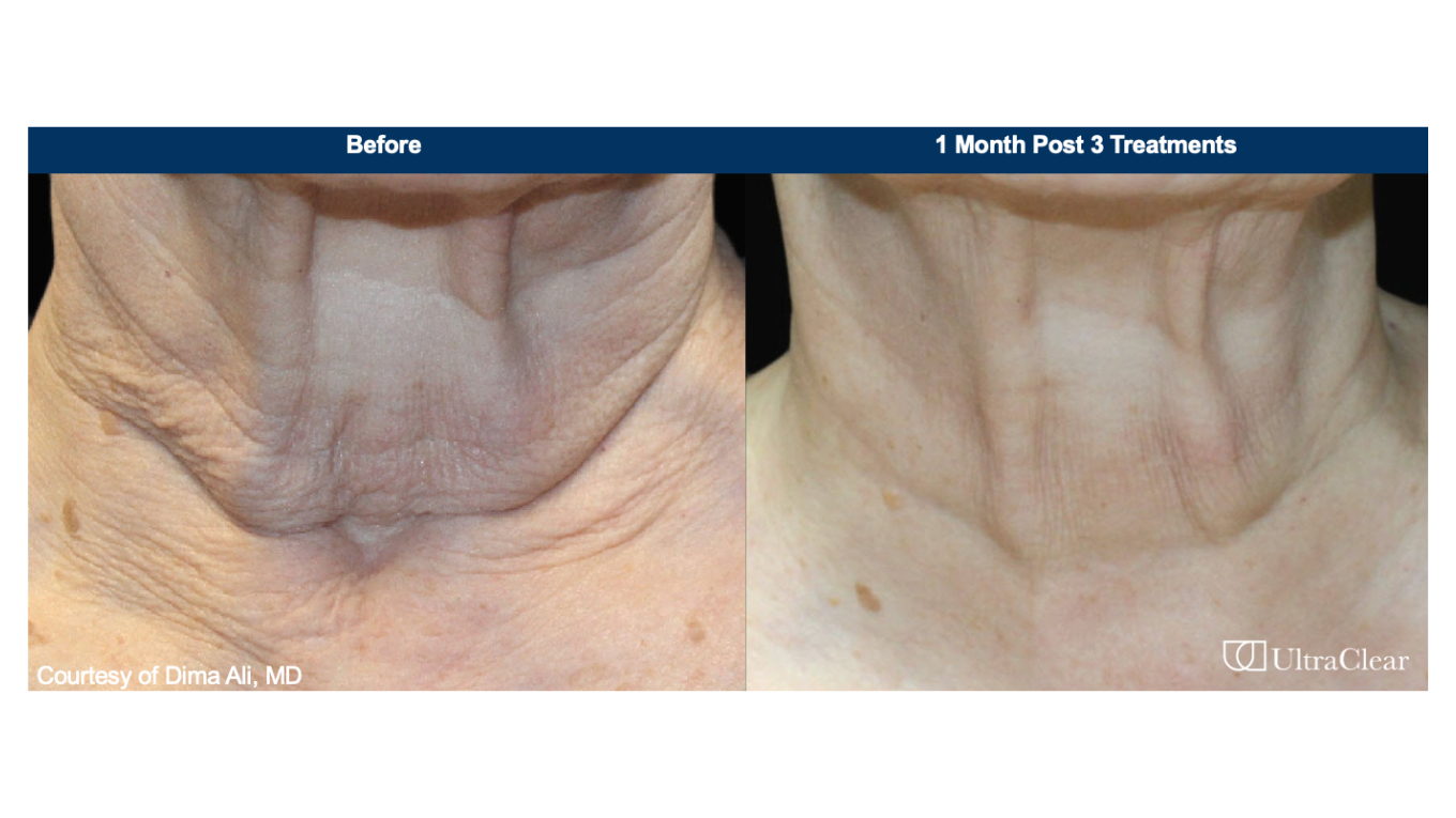 UltraClear® Radical Rejuvenation Results - Central Wellness Medical ...